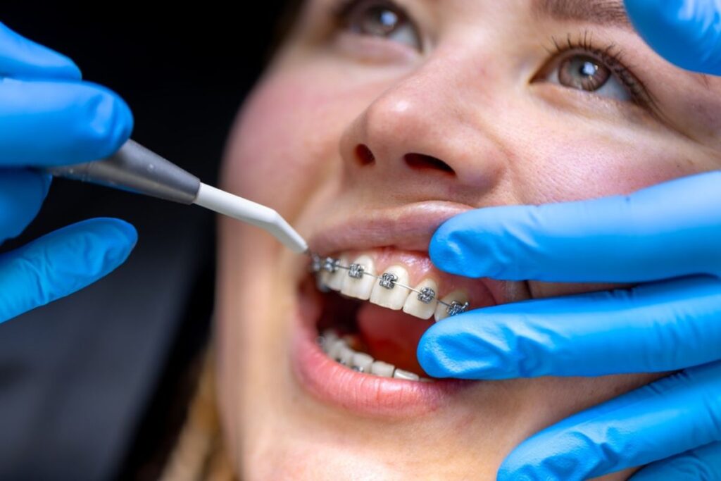 Your Braces Are Coming Off! Here’s What Happens Next | Schroeder ...