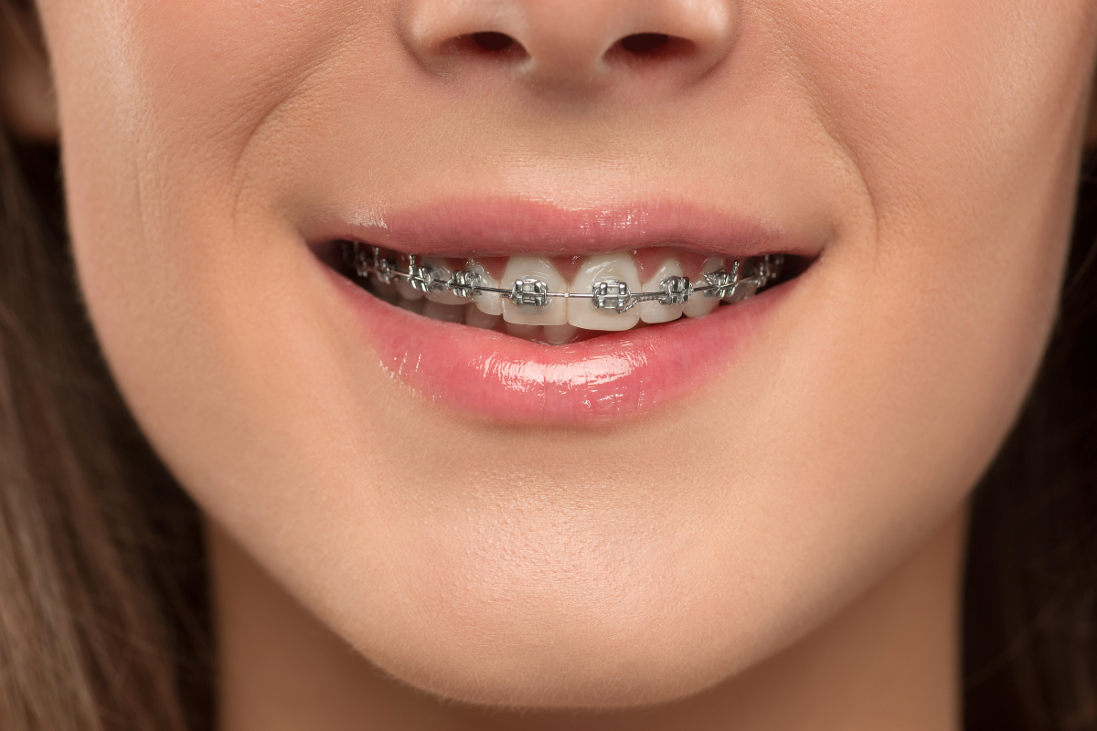 Too Old for Braces? Here’s What Orthodontists Say